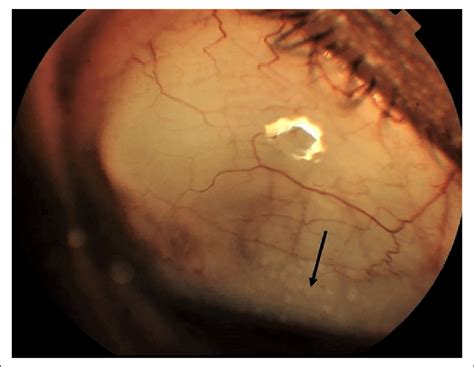 Three Months Postoperative Picture Showing A Healthy Diffuse Posterior Download Scientific