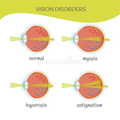 Conjunctivitis Symptoms Pink Eye Disease Infection And Allergy Stock