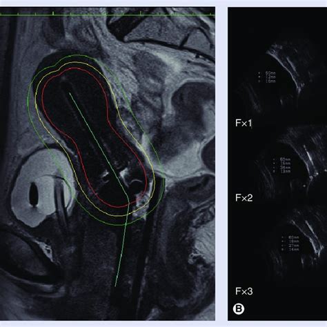A Planning Mri With The Tandem And Ovoids In Situ Showing The 100