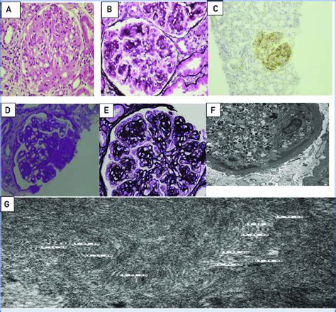Pathology Of Membranoproliferative Glomerulonephritis With Monoclonal