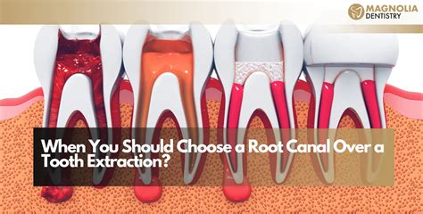 When You Should Choose A Root Canal Over A Tooth Extraction Magnolia
