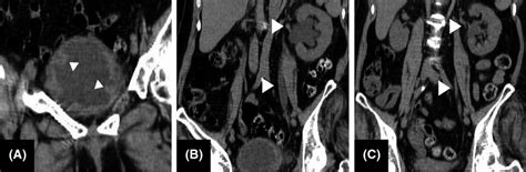 Abdominal Ct Images Taken At Admission Showed Trabeculated Bladder A