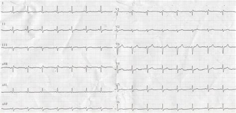 Example Of A Full 12 Lead Electrocardiogram Ecg Download Scientific