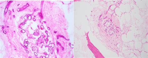 Maxillary Sinus Hematoxylin And Eosin Stain Hande 60× And 20× Showing