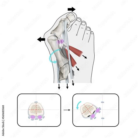 Stock Illustration „무지외반증 해부학 메디컬일러스트“ Adobe Stock
