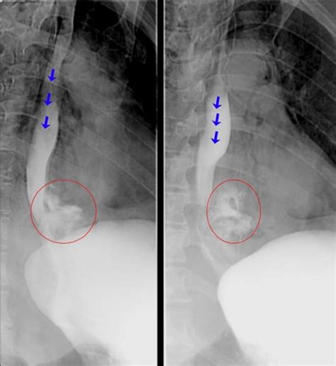 Esophageal Rupture Gastrointestinal Disorders Msd Manual