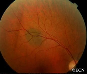 What Does Melanoma On The Eye Look Like
