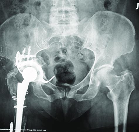 X Ray Of The Pelvis In A Direct Projection Of A Patient With Neuropathy