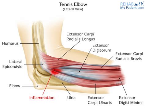 Lateral Epicondylitis Lateral Epicondylitis Tennis Elbow
