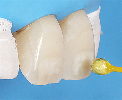 Clinical Case Black Triangle Closure Using Bioclear© Bt Matrices 3m