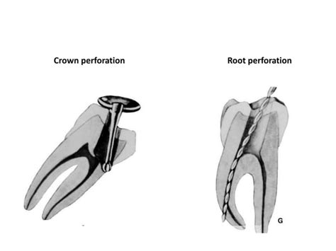 Access Cavity Preparation Pptx