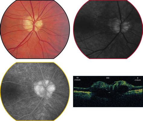 Congenital And Developmental Anomalies Of The Optic Nerve Ento Key