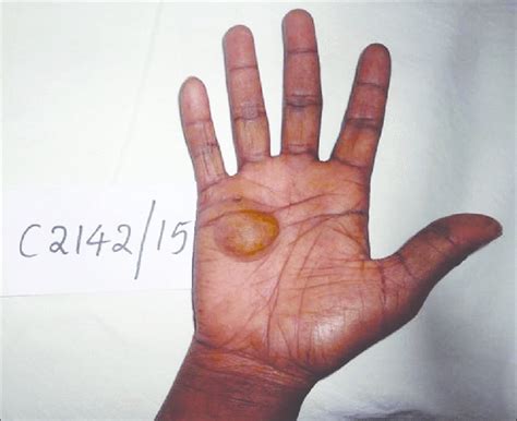 Swelling Between Fourth And Fifth Metacarpal Spaces Over The Palmar Download Scientific Diagram