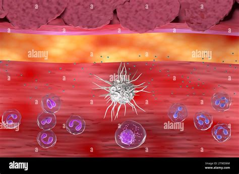 Inflammatory Skin In Eczema Atopic Dermatitis Ad Top View 3d