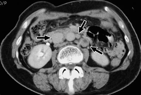 Mr Imaging Of The Uterine Cervix Imaging Pathologic Correlation