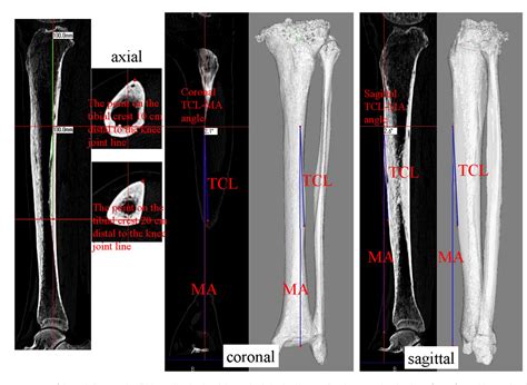 Figure 3 From The Tibial Crest As A Practical Useful Landmark In Total