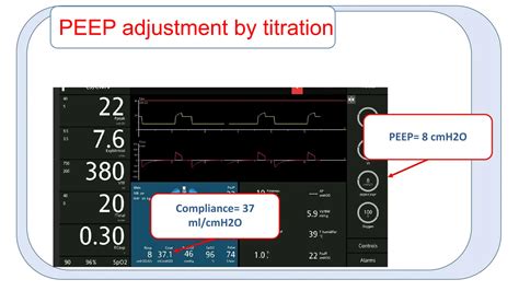 New Ards Management Guideline Who Pptx