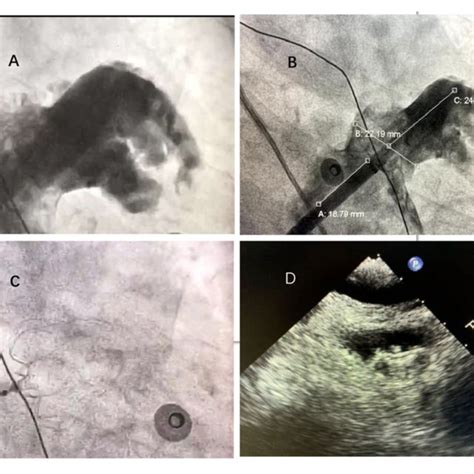 Pdf Effect Of Left Atrial Appendage Closure In Combination With Catheter Ablation On Left