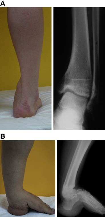 A Compensation Of A Distal Tibial Varus Deformity With Subtalar Download Scientific Diagram