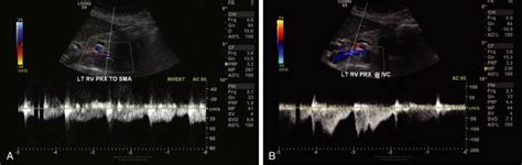 Renal Vein Entrapment The Nutcracker Syndrome Clinical Tree