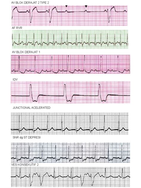Bahan Ujian Ekg Strip 1pptx Pdf