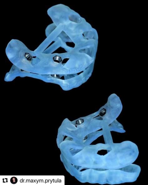 Guided Surgery As An Alternative To Subantral Augmentation Surgical