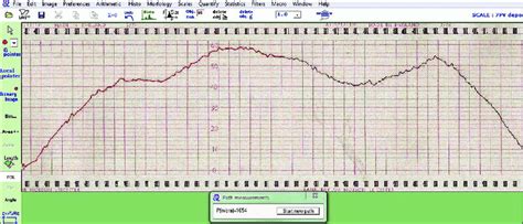 Quantikov Measurement Of Enamel Roughness After Acid Etching