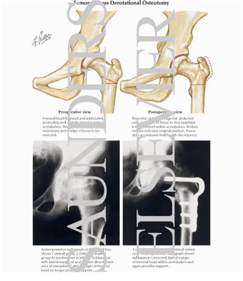 Varus Osteotomy Meddic