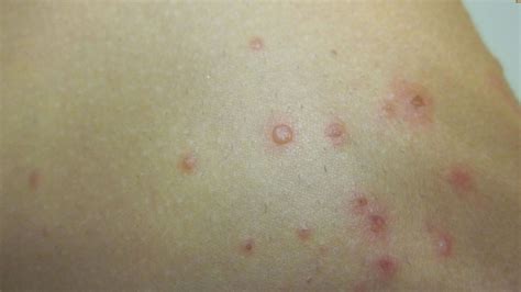 34 Facts About Varicella