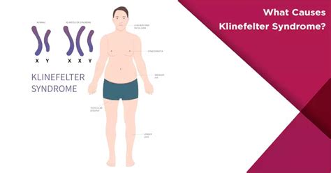 Klinefelter Syndrome Xxy Syndrome Symptoms Causes 56 Off