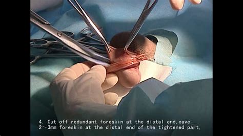 Circumcision With Ring Xxx Porn