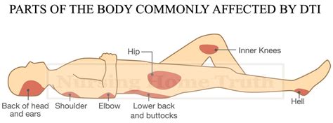 Deep Tissue Injury Treatment 2023 Updated Research