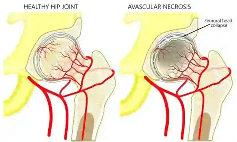 Avascular Necrosis Femoral Head Avn Symptoms Causes And Treatment