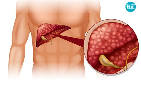 Crash Dieting Living Sedentary Life Cause Gallbladder Stones Physician Warns Of 5 Everyday