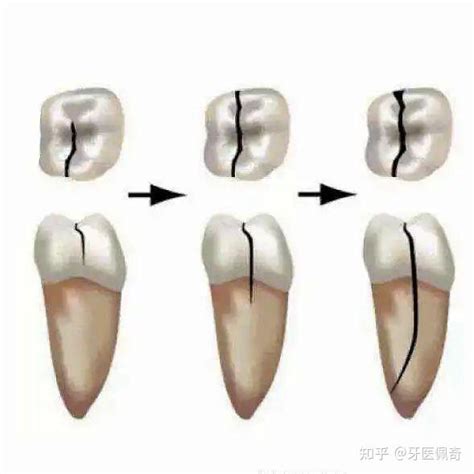 根管治疗以后牙齿裂了该怎么办 知乎