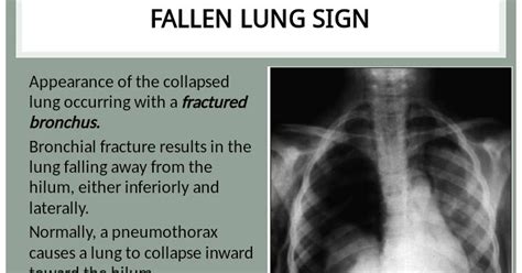 Chest Medicine Made Easy Dr Deepu Fallen Lung Sign