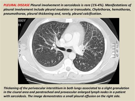 Presentation1 Pptx Radiological Imaging Of Sarcoidosis