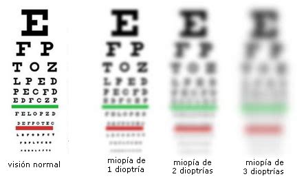 Miopía