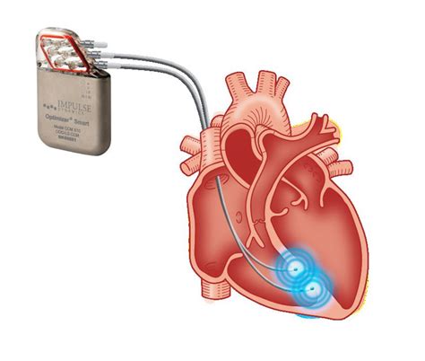 Optimizer Smart Impulse Dynamics