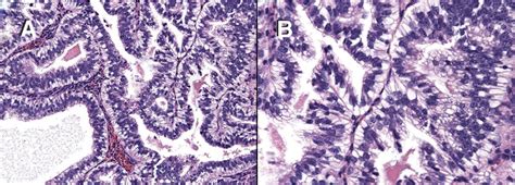 Secretory Hyperplasia A Hyperplastic Endometrial Glands With