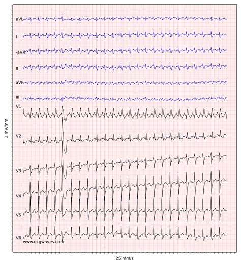 Atrial Flutter Classification Causes Ecg Criteria And Management The Cardiovascular