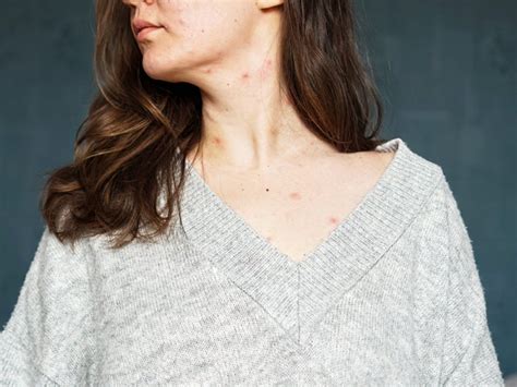Colloidal Silver For Acne Possible Benefits Safety And More