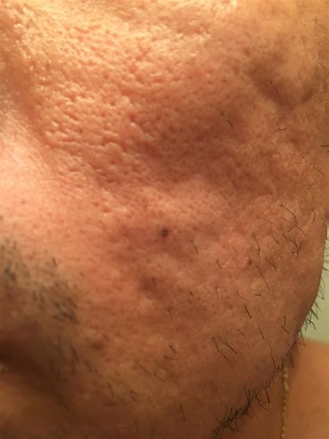 Help Please Severe Acne Scars Hypertrophic Raised Scars