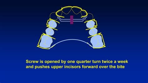 Transverse Malocclusion Crossbite Pptx