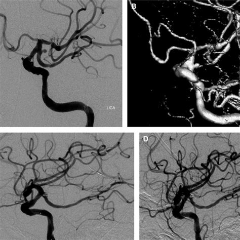 Hunt And Hess Grades Download Table