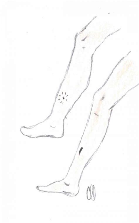 Open Fractures Gustilo Anderson Classification
