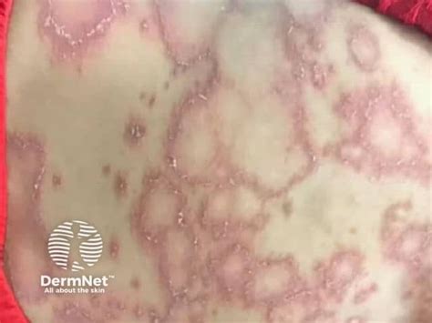 Annular Erythema Images