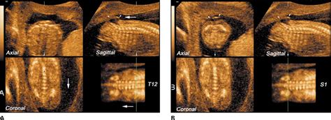 Spina Bifida 3d Ultrasound