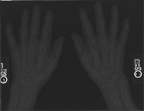 github nikhilkethu bone fracture recognition using deep neural network