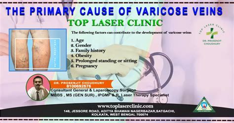 6 Primary Cause Of Varicose Veins